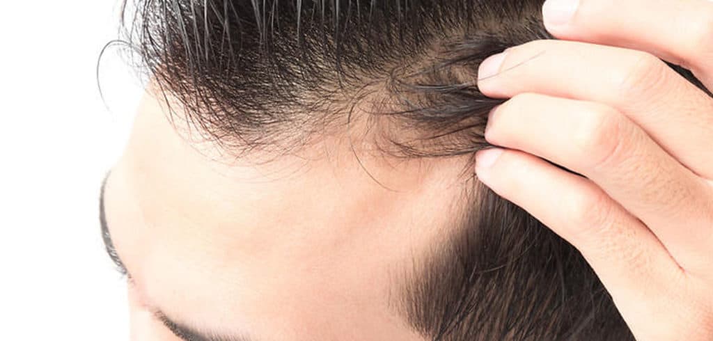 Hairline, What Does Different Types Mean? - RepHair