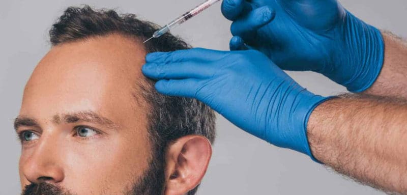Prp capelli: una cura alternativa alle calvizie. Funziona davvero ...