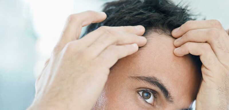 Hairline, What Does Different Types Mean? - RepHair